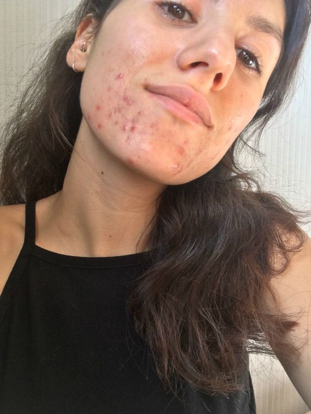 Acne Lololon